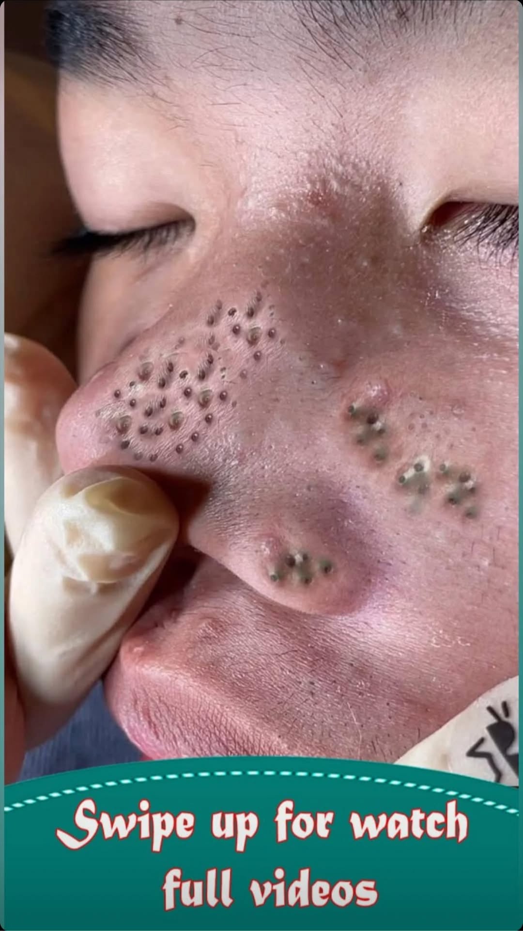 Tips For Squeezing Blackheads On Nose - Usa Press